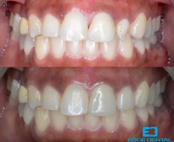 What is Cosmetic Bonding? | Learn More About Cost of Cosmetic Bonding